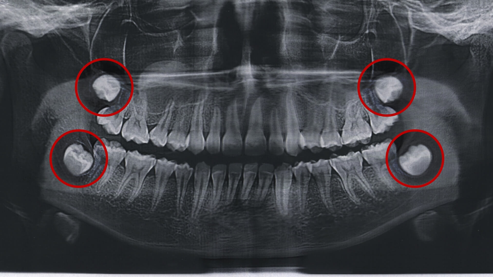 a painful pressure in your wisdom teeth area also see a dentist as soon ...