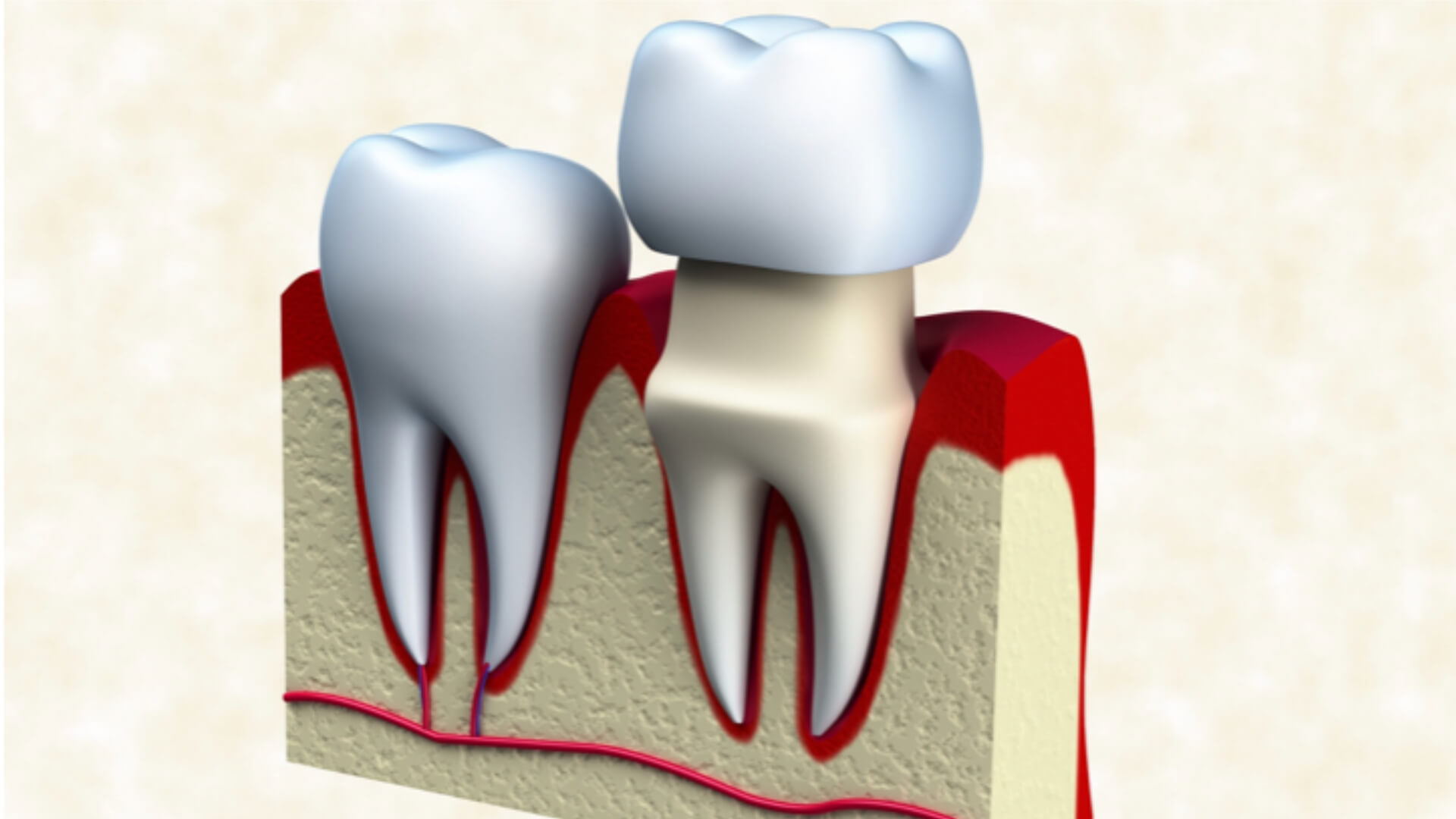 your best best is to get to the dentist as soon as you can because you ...